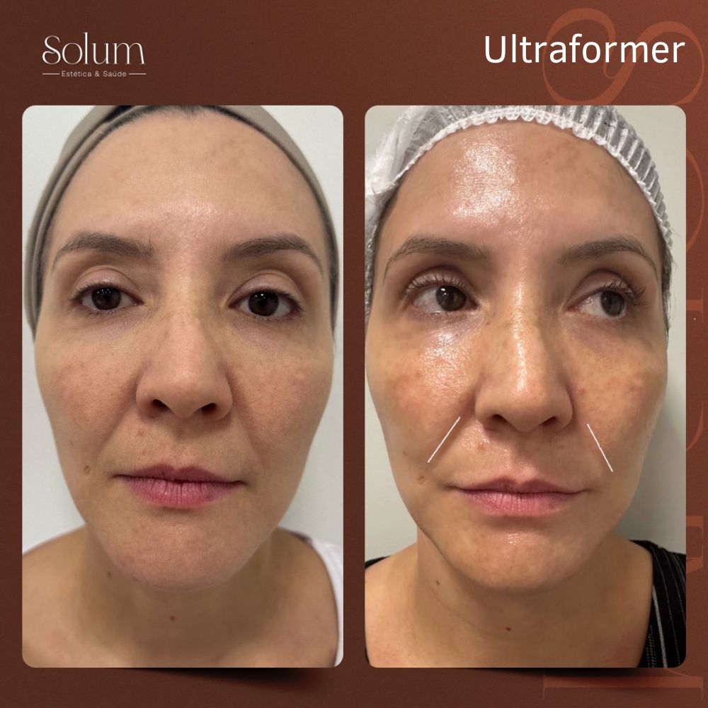 LP Ultraformer - Solum Clinica