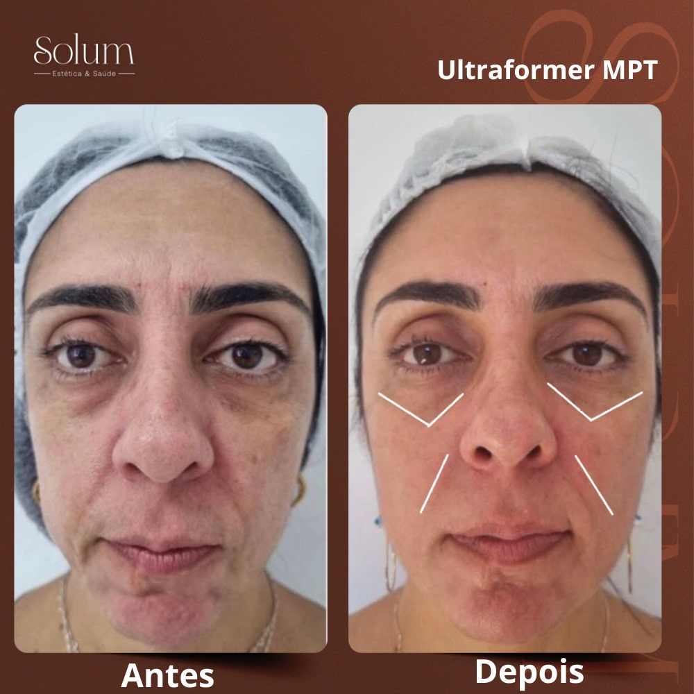 LP Ultraformer - Solum Clinica